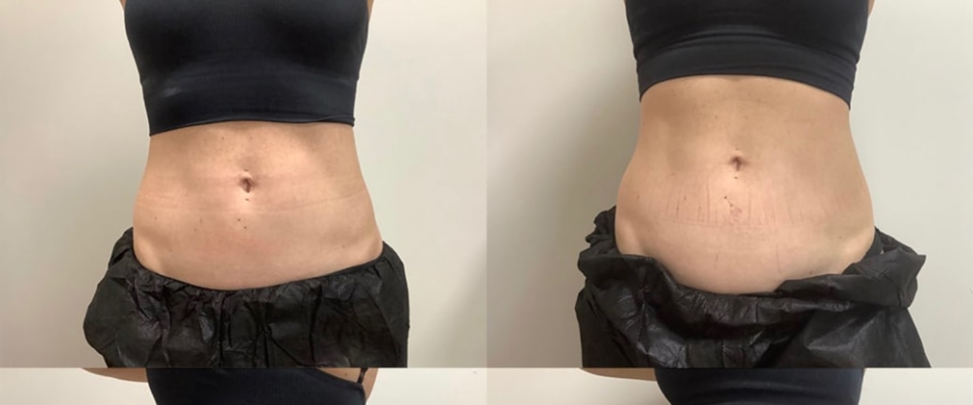 What's cool sculpting?